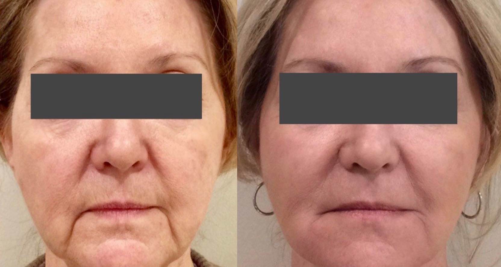 Can You Get Rid of Marionette Lines? - Infinity Aesthetics